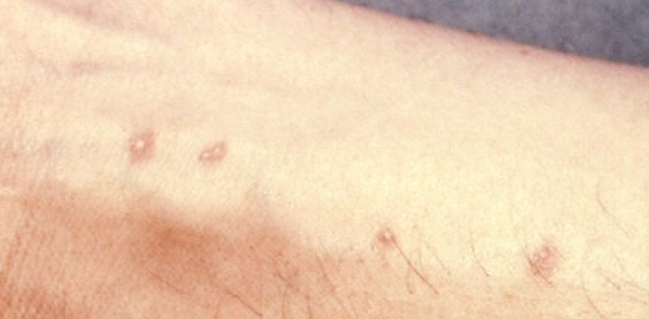 Schistosomiasis Causes Symptoms Diagnosis Treatment